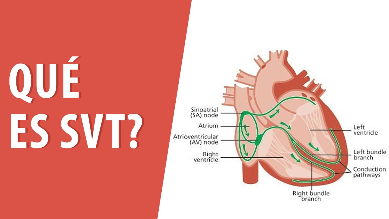 Qu Es SVT CardioVisual Trusted Patient Education Platform Qu Es SVT CardioVisual Trusted Patient Education Platform