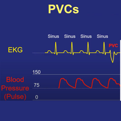 Understanding 'extra heart beat' or PVC
