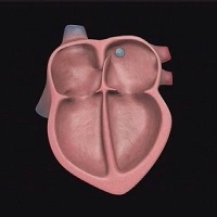 How PFO causes stroke