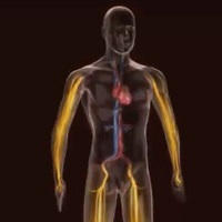 JetStream atherectomy