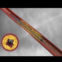 Diamondback Atherectomy