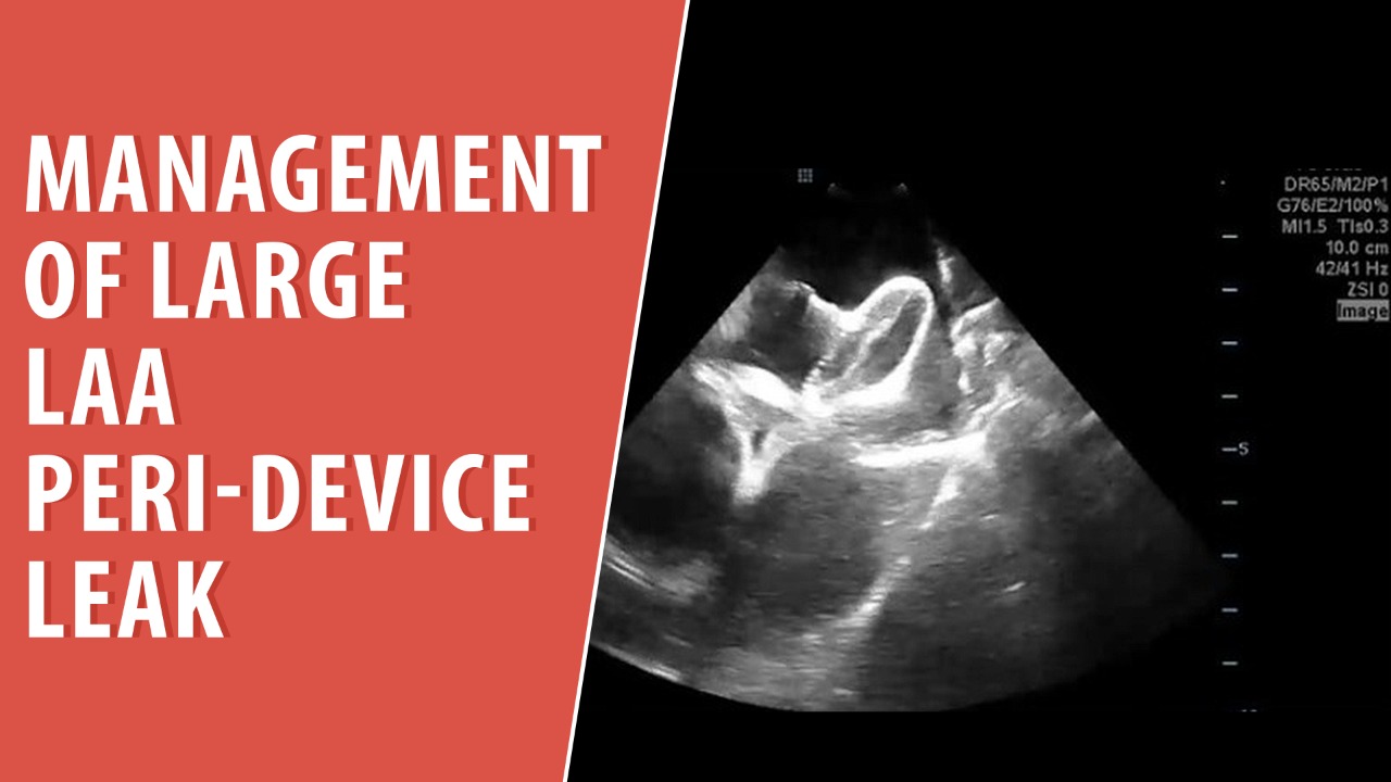 Management of Large LAA Peri-device Leak