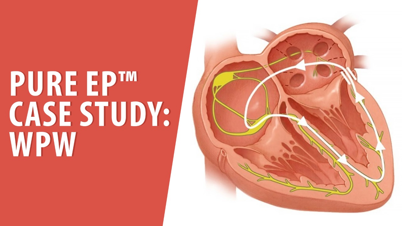 PURE EP™ Case Study: WPW | CardioVisual: Heart Health App Built by ...