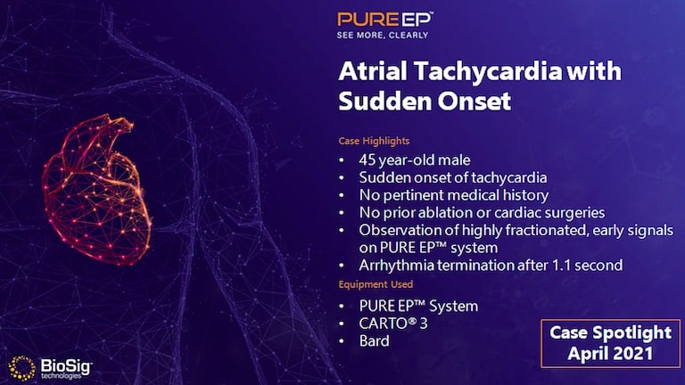 PURE EP™ Case Study: Atrial Tachycardia