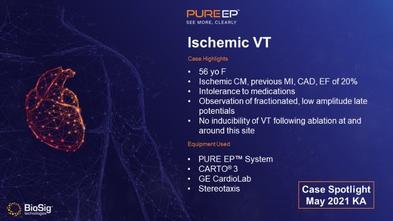 PURE EP™ Case Study: Ischemic VT