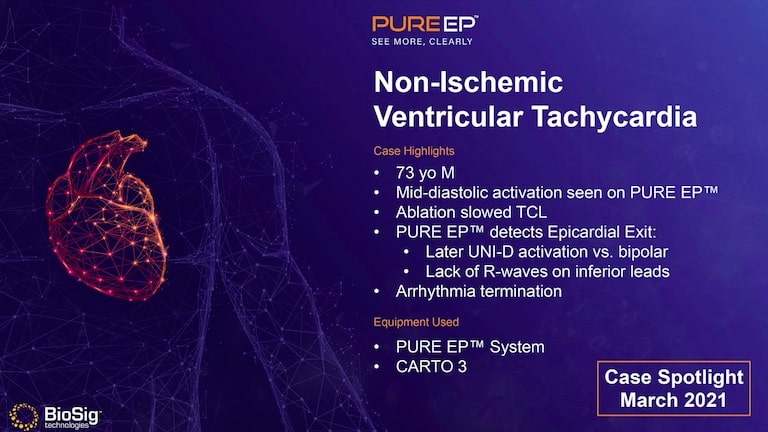 PURE EP™ Case Study: Non-Ischemic VT