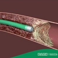 JetStream atherectomy