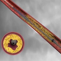 JetStream atherectomy