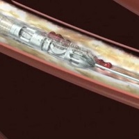 JetStream atherectomy