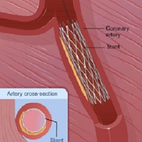 Athletes and heart disease