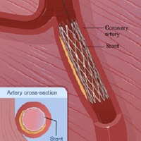 Athletes and heart disease