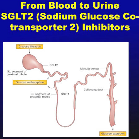 SGLT2 Inhibitors for Diabetics