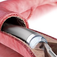 JetStream atherectomy