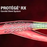 Carotid stent & Filter