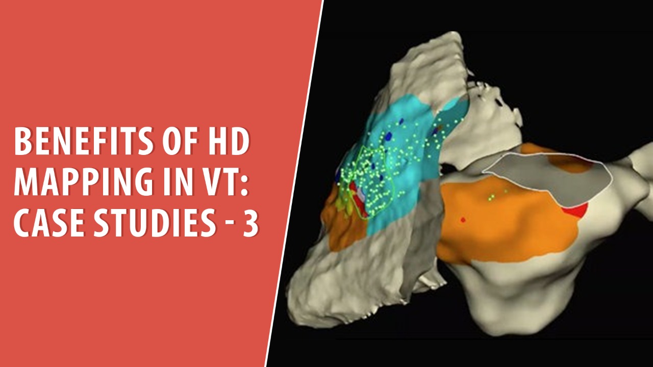 Benefits of HD Mapping in VT: Case Studies - 3
