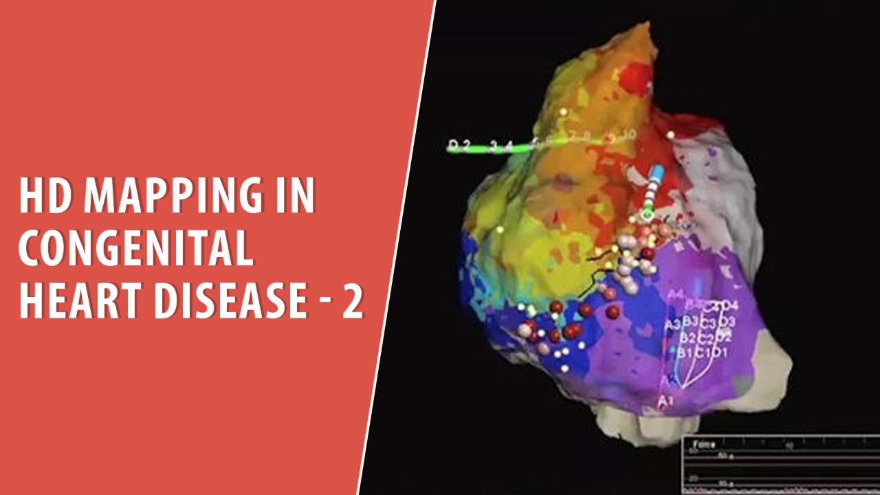 HD Mapping in Congenital Heart Disease - 2