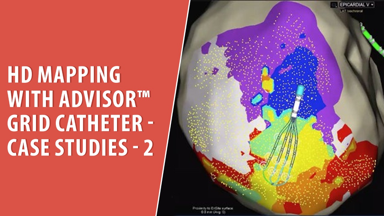 HD Mapping with Advisor™ Grid Catheter - Case Studies - 2