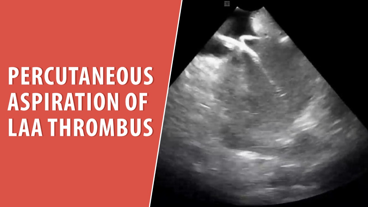 Percutaneous Aspiration of LAA Thrombus